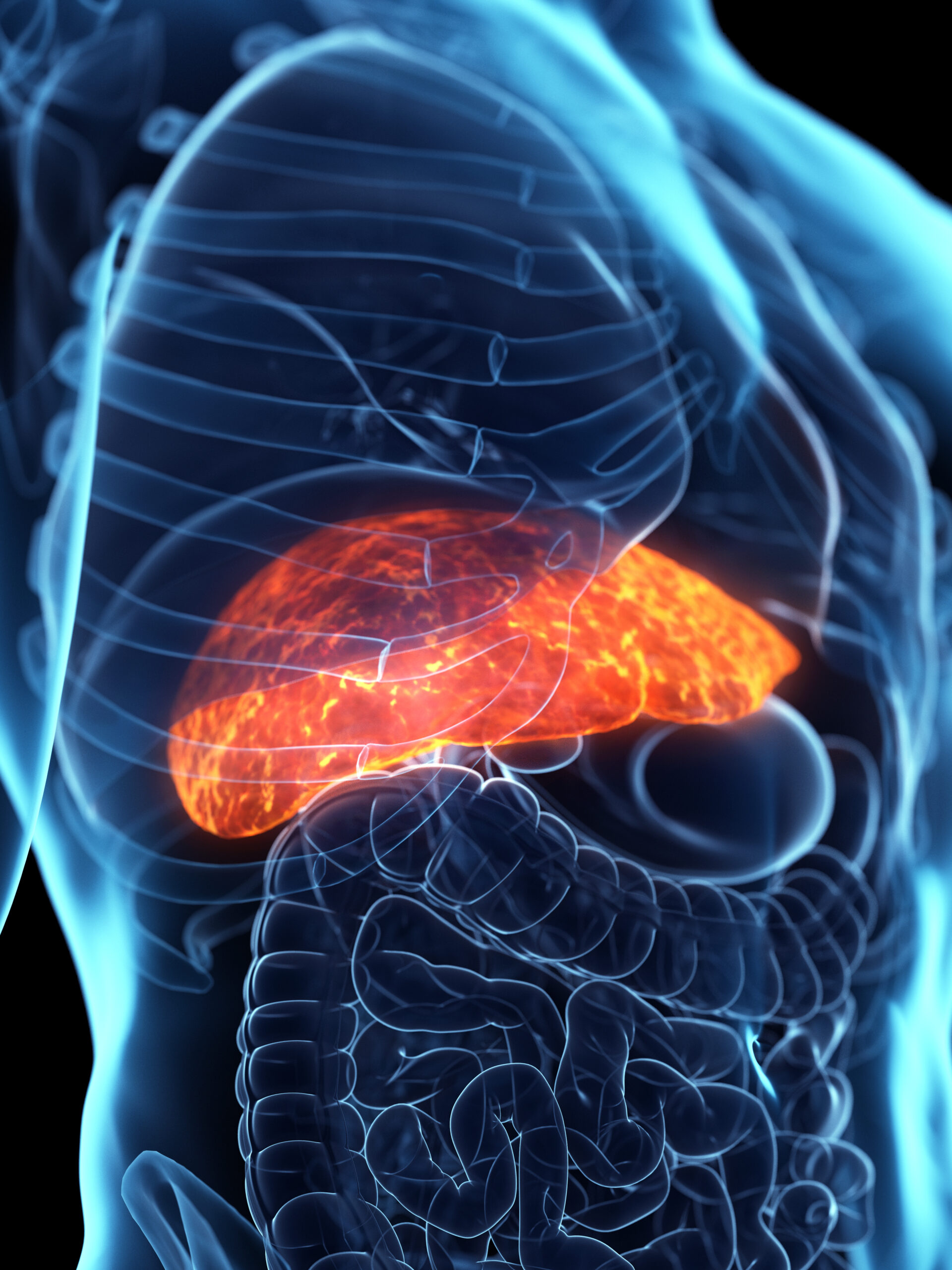 Getting GRIP on NASH: Implementation of an international screening ...